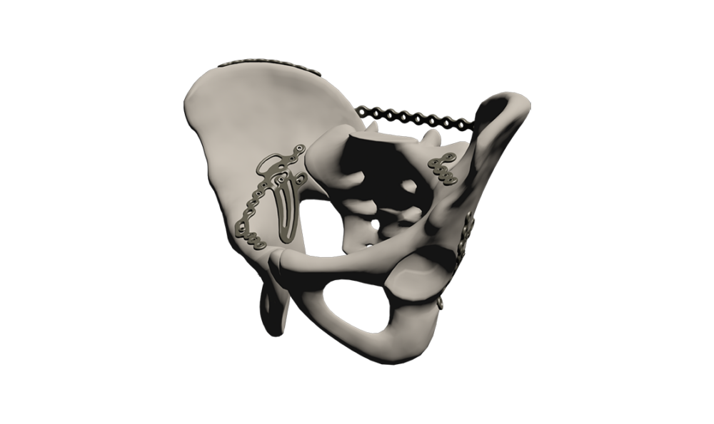 Pelvic Reconstruction System Phoenix (PRSPHX) | ITS Implant - DE