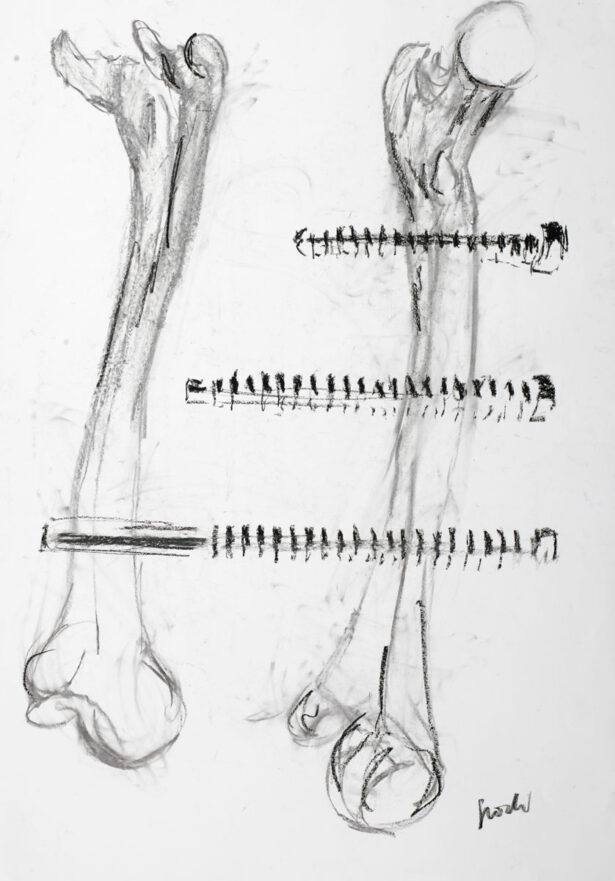 Headless Compression Screws (HCS) | ITS Implant - USA